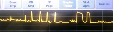 How To Interpret Inpatient Cardiac Telemetry Marc Katz Md