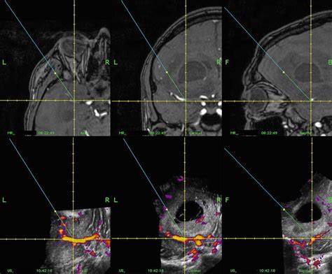 Intraoperative Ultrasound In Neurosurgery Radiology Key