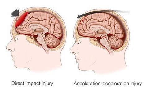 Physiotherapy Treatment For Concussion Physiovive