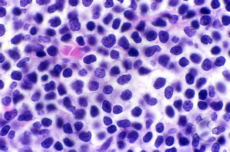 Mantle Cell Lymphoma 6