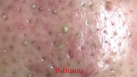 Best Removal Of Blackhead On Nose With Tweezer B Beauty 23 Youtube