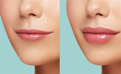 Pdo Threads Lips Before And After Diaminyaesthetics