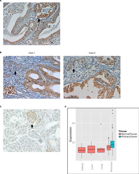 Overexpression Of Podxl Itgb1 And Bcl7b Itgb1 Accurately Predicts Unfavorable Prognosis Compared