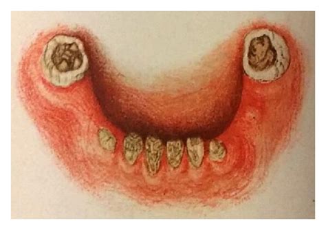 Congenital Syphilis Teeth