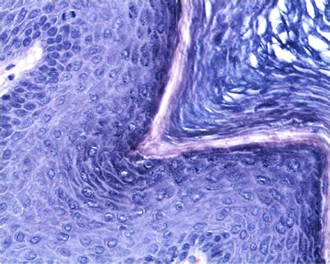 Condyloma Acuminatum Genital Warts Dermatology Advisor