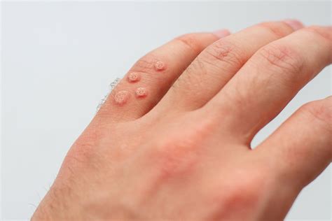 ¿cuál Es El Tratamiento Para El Papiloma En La Mano
