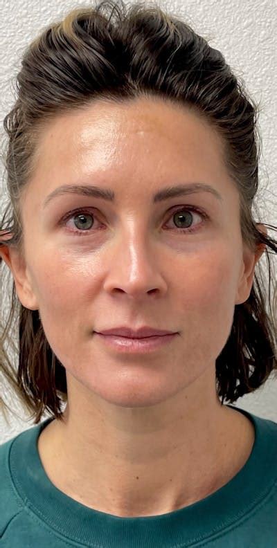 Sciton® Halo Before And After Photos Setty Plastics And Aesthetics