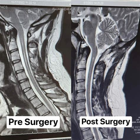 Pre And Post Op Mri Rchiari