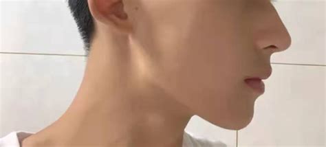 男生如何祛痘和去痘印？ 知乎