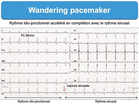 Ekg 51 Wandering Atrial Pacemaker