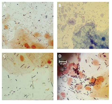 Microscopic Diagnosis Of Bacterial Vaginosis Epithelial Cell Socalled