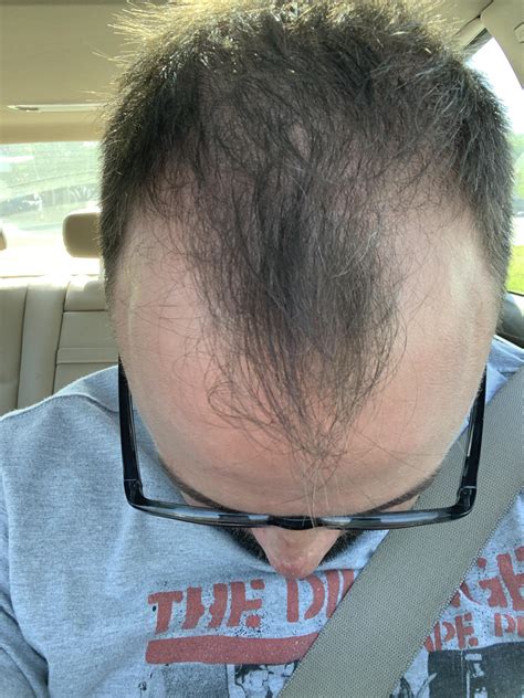 Thoughts R Hairtransplants