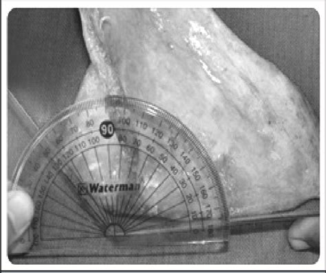 Measurement Of Medial Angle Download Scientific Diagram