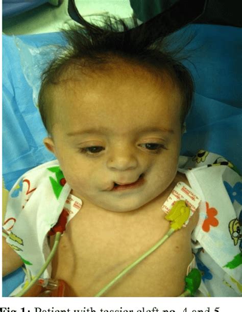 Figure 2 From A Bilateral Tessier Number 4 And 5 Facial Cleft And