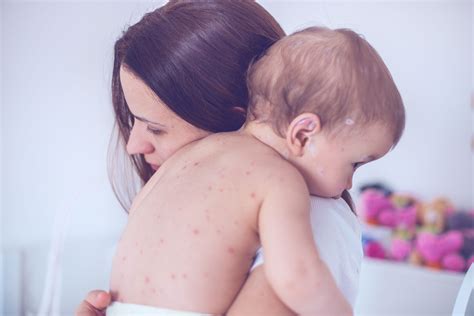 La OMS Y Unicef Dijeron Que Se Avecina Una Tormenta Perfecta Subieron Los Casos De