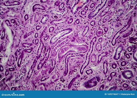 Diffuse Proliferative Glomerulonephritis Stock Image Image Of Microphotograph Medicine 169274647