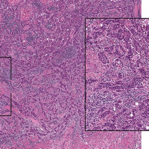 Representative Pictures Of Immune‐excluded Phenotype In Oral Tongue Download Scientific Diagram