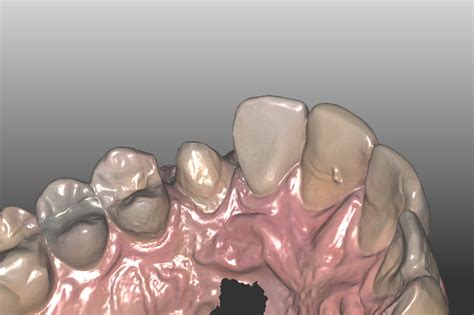 Dental Lab Solutions Retraction Cord Pd Ceramics Ltd