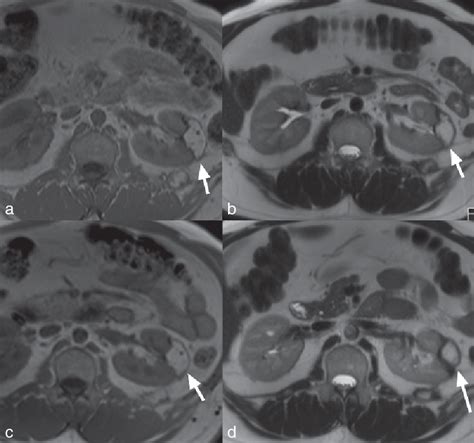 Figure 110 From Subtotal Nephrectomy And Tumour Ablation Semantic
