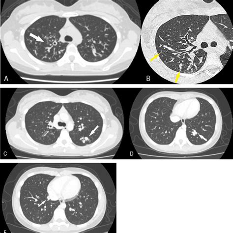 Axial Ct Scans Of The Chest A Bronchiectasis Is Present Download Scientific Diagram