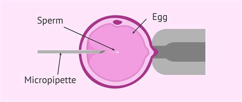 Intracytoplasmic Sperm Injection What Is Icsi And How Much Is It