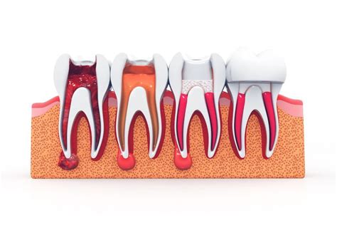 what is a root canal procedure and why you shouldn t fear it dental
