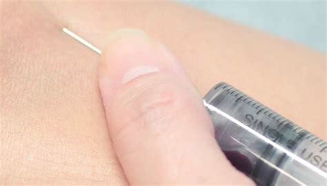 Prueba Cutánea De Ppd Para La Tuberculosis Salud Tudo