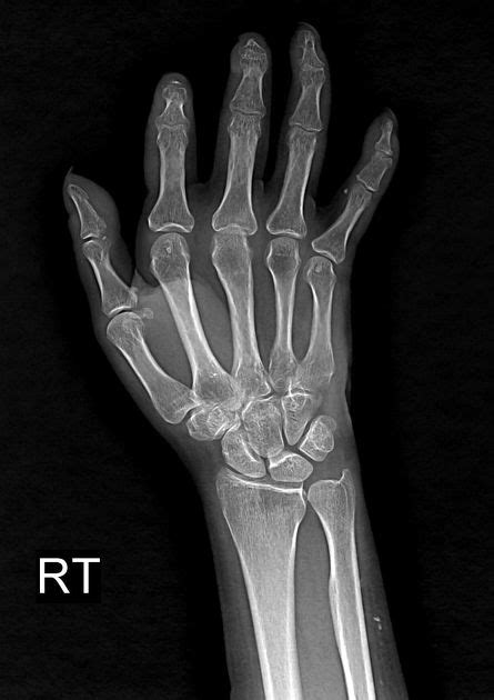 Crest Syndrome