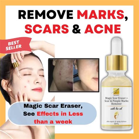 Niceahh Magic Scar Eraser Scar And Pimple Marks Remover Pantanggal