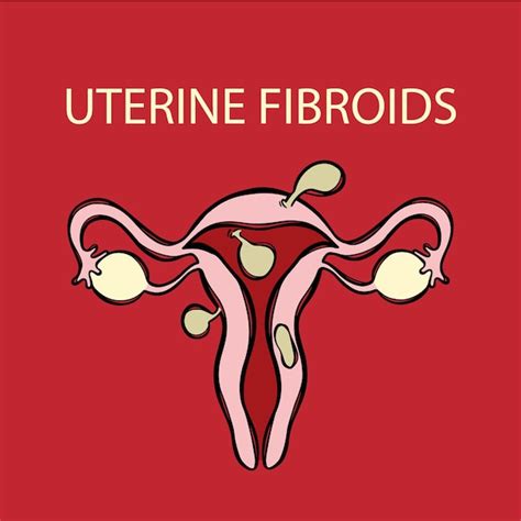 Premium Vector Uterine Fibroids Vs Normal Female Reproductive Education Set