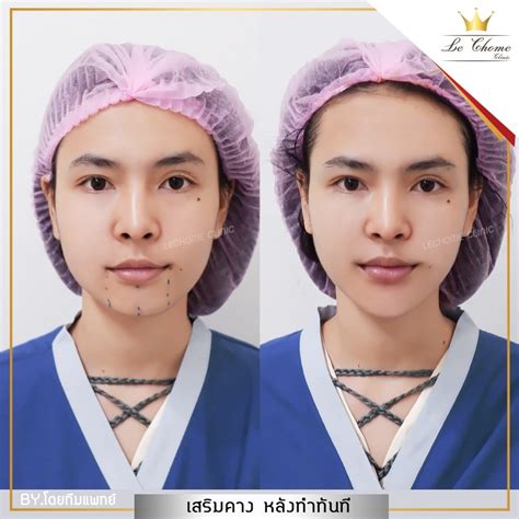 พรุ่งนี้รวย รีบมาสวยกันเร็ว🔥กับเคสเสริมคาง หลังทำเสร็จทันที 💡 เสริมคาง