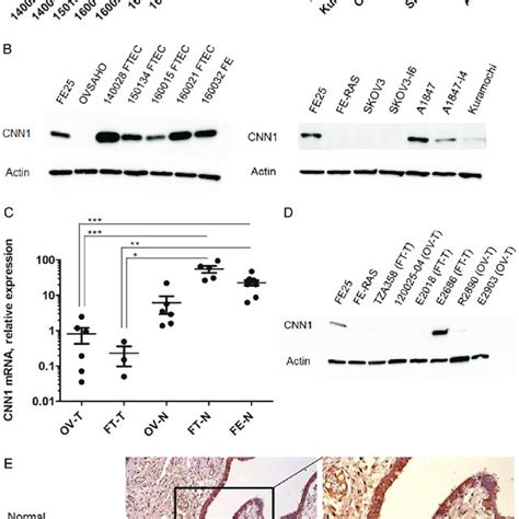 CNN1 Is Downregulated In The Development Of HGSC And In Invasion