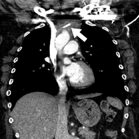 Coronal View Of Computed Tomography Venogram Of The Chest The White