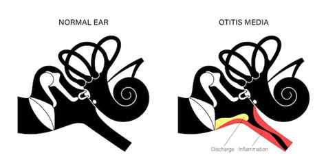 Premium Vector Otitis Media Disease