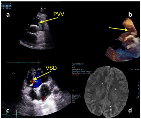 Pulmonary Valve Endocarditis During And Beyond Euro Endo Registry A