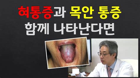 혀통증과 목안 통증목이물감이 함께 나타난다면 구분해야할 원인 질환 타액분비저하 구강건조 역류 후비루 Youtube