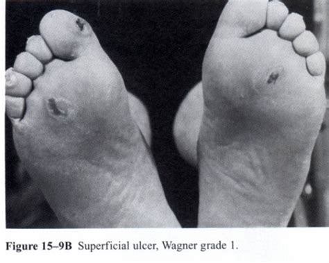 Wagner Classification Scale Flashcards Quizlet