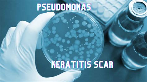 Pseudomonas Keratitis Scar Dr Anthony Maloof