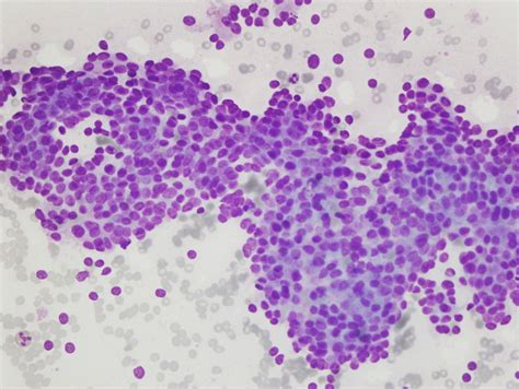 Pathology Outlines Parathyroid Tissue Parathyroid Adenoma And Variants