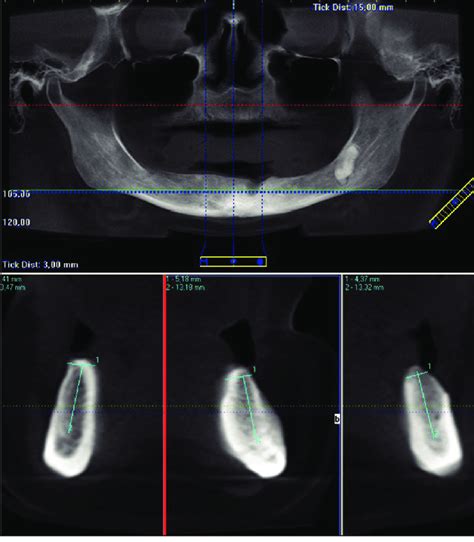 The Height Of Both The Maxillary And Mandibular Alveolar Processes Was Download Scientific