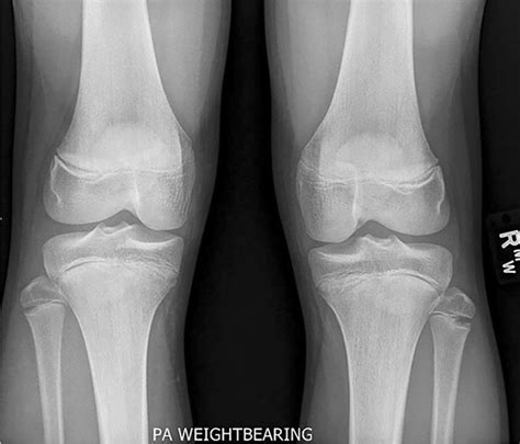 A Posteroanterior Pa Weight Bearing Knee Radiograph In A 15 Year Old