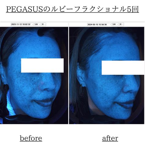 No10ルビーフラクショナル5回 ペガサスクリニック 若返りのかかりつけ医 井上礎馬drの症例写真を日々、更新中