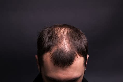 How To Fix Bald Spots And Regrow New Hair In Men