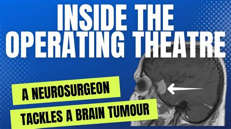 Real Life Brain Tumour Surgery Removing A Meningioma Youtube