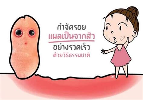 U Skin Beauty 6วิธีกำจัดรอยแผลเป็นจากสิว