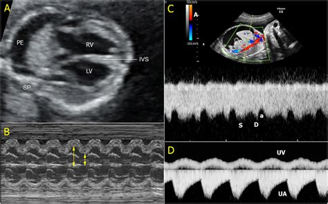 An Example Of Low Output Hydrops Foetalis A The Four Chamber View
