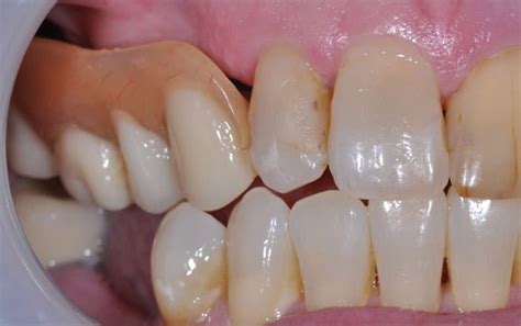 Semi Precision Root Anchors For Partial Dentures Decisions In Dentistry
