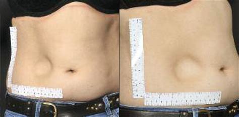 Progressive And Disabling Lipoatrophy Associated With Insulin Aspart Via A Continuous