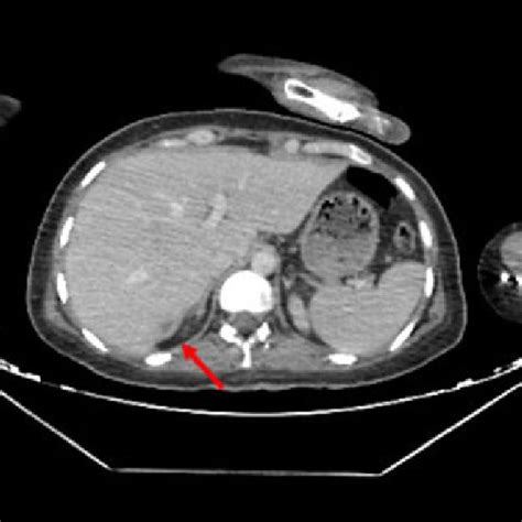 Thyroid Scan No Uptake At Thyroid Bed Download Scientific Diagram
