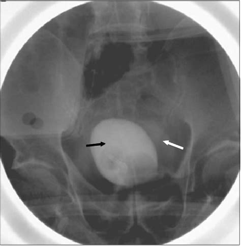 Cystographic Finding Shows The Contrast Leakage White Arrow In The